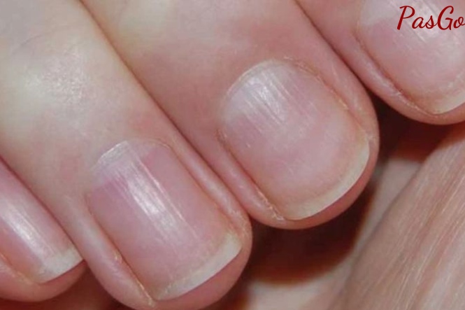 Móng tay bị sần gợn sóng là THIẾU CHẤT gì, phản ánh gì về sức khỏe?